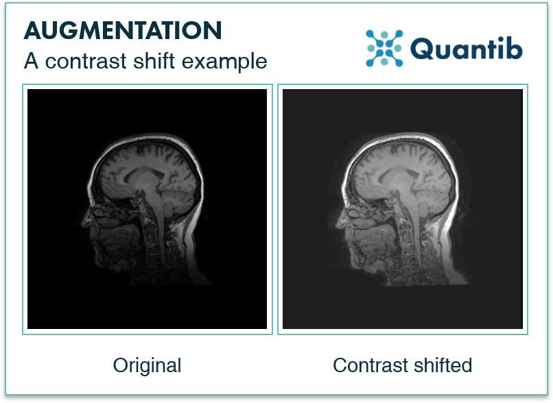 Image augmentation: how to overcome small radiology datasets