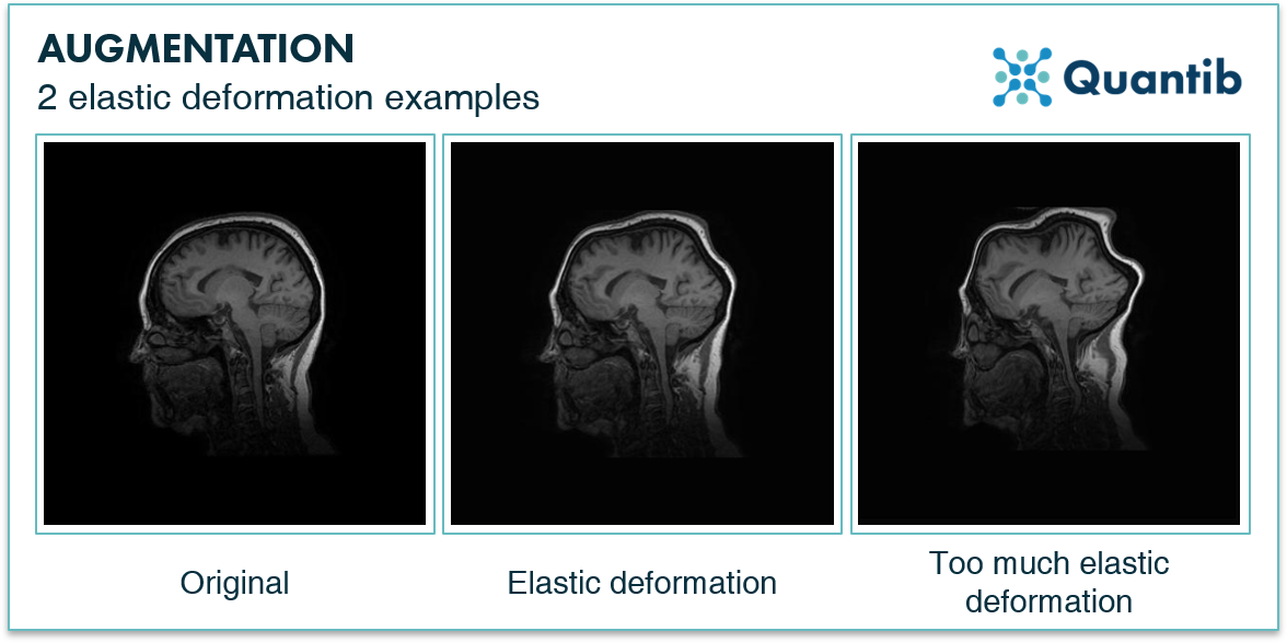 Image augmentation: how to overcome small radiology datasets