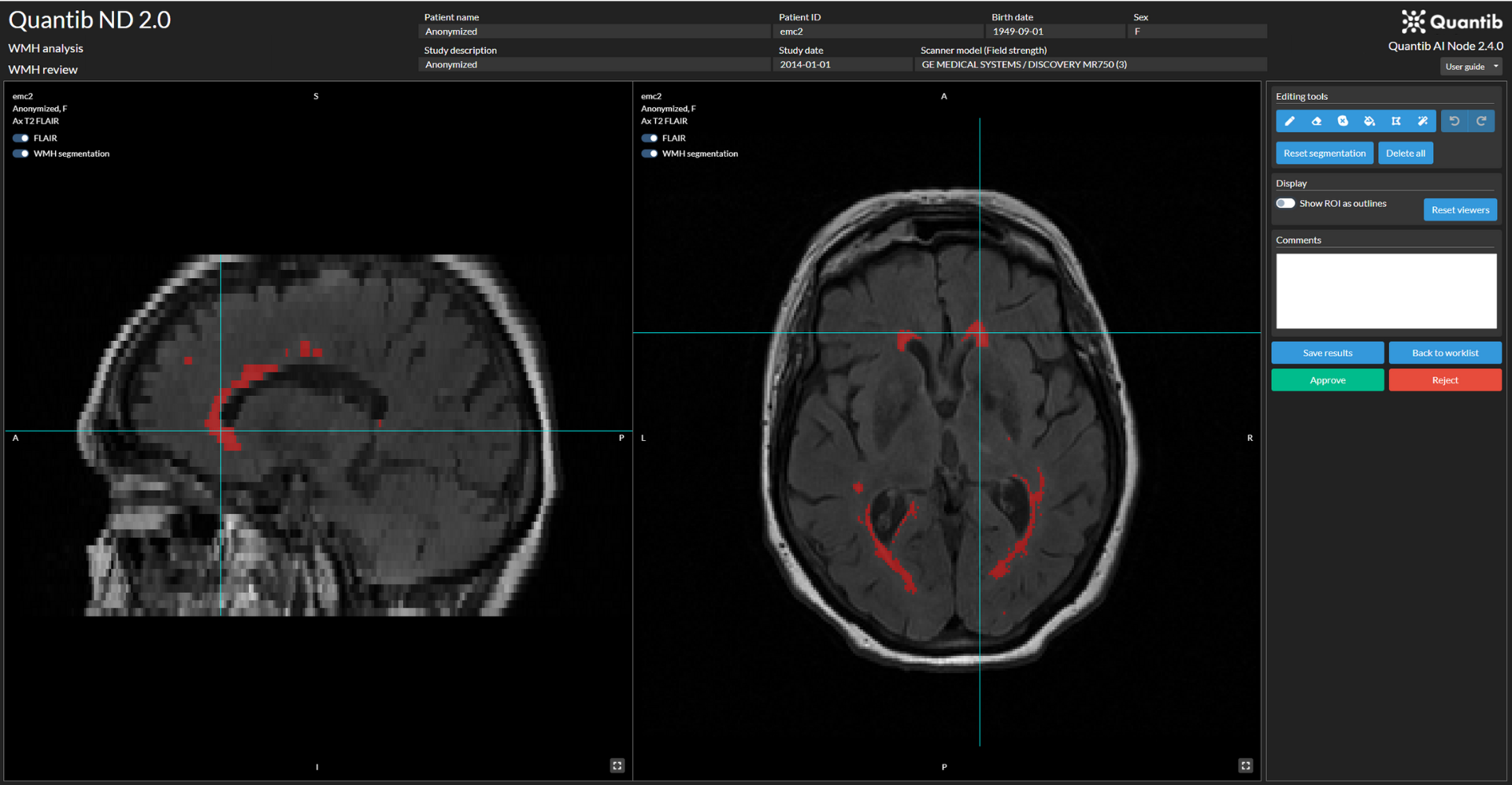 Brain Segmentation Software - Quantib Neurodegenerative (ND)
