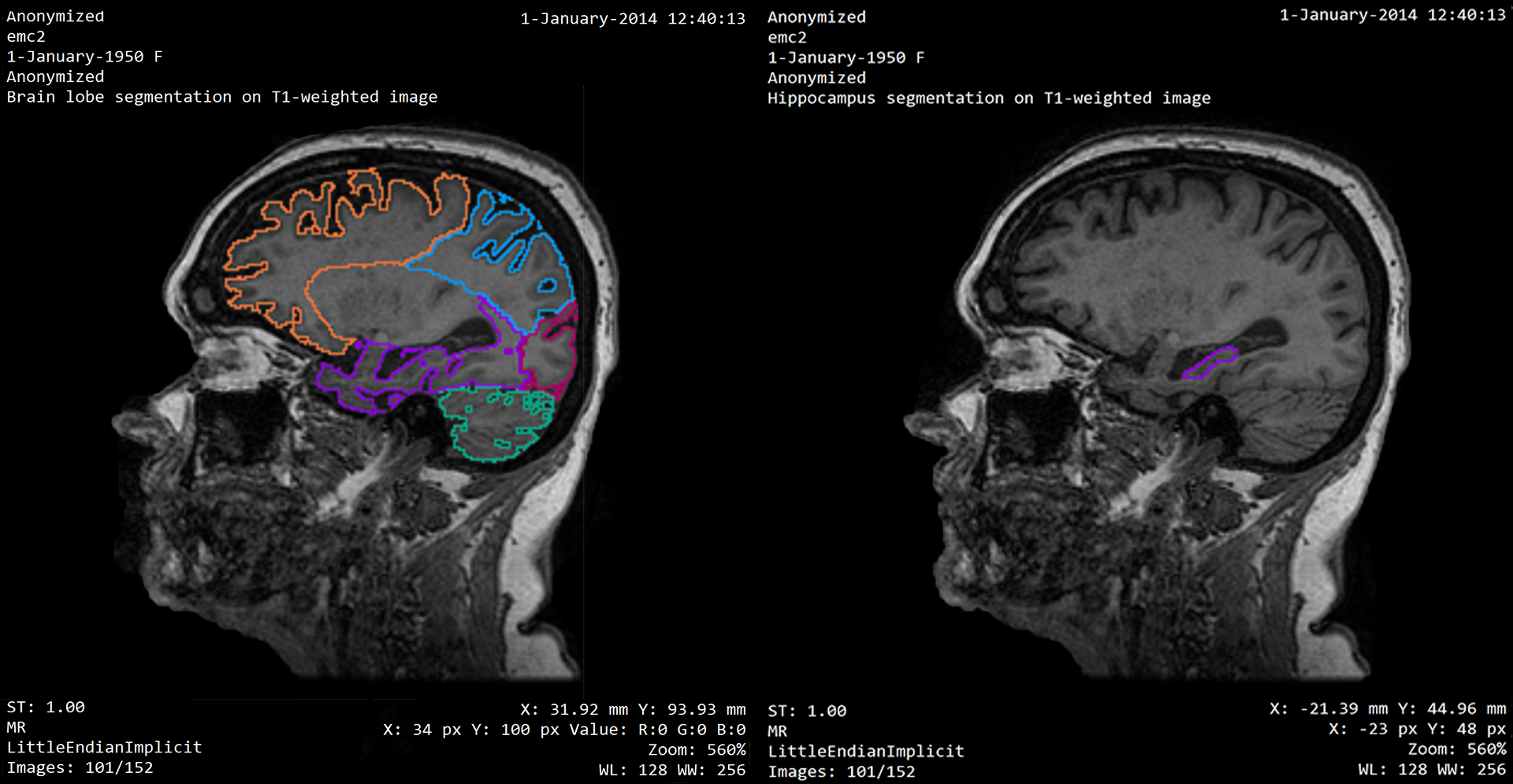 Brain Segmentation Software - Quantib Neurodegenerative (ND)