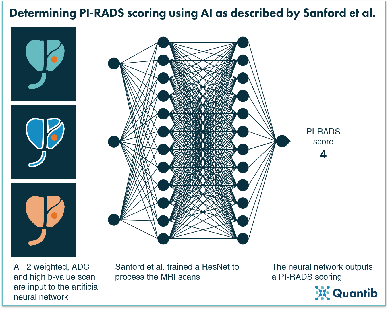 AI in prostate cancer: 6 'must-read' papers