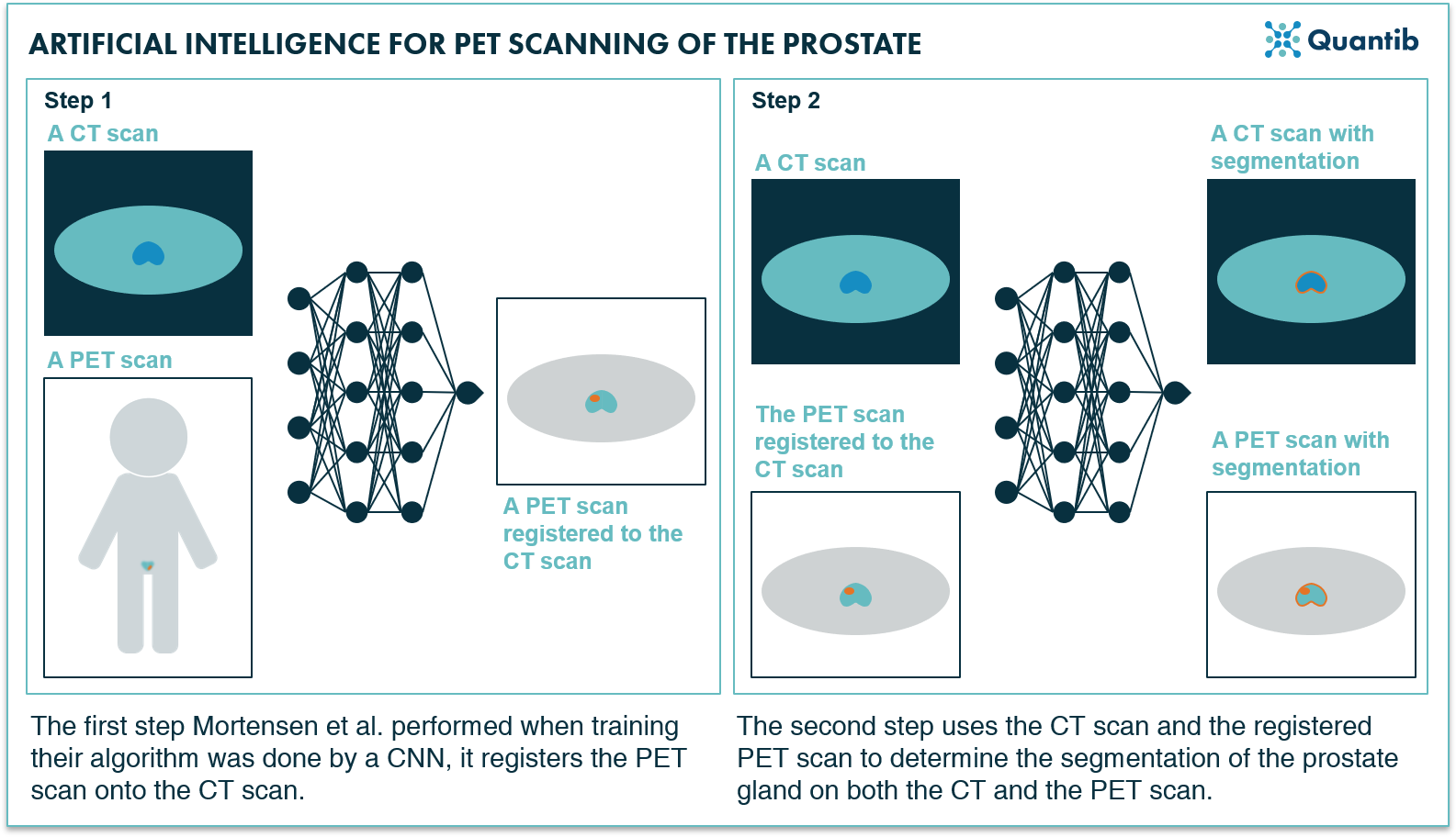 AI in prostate cancer: 6 'must-read' papers