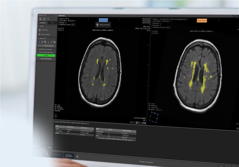 Medical Image Analysis Software Development | Quantib BV