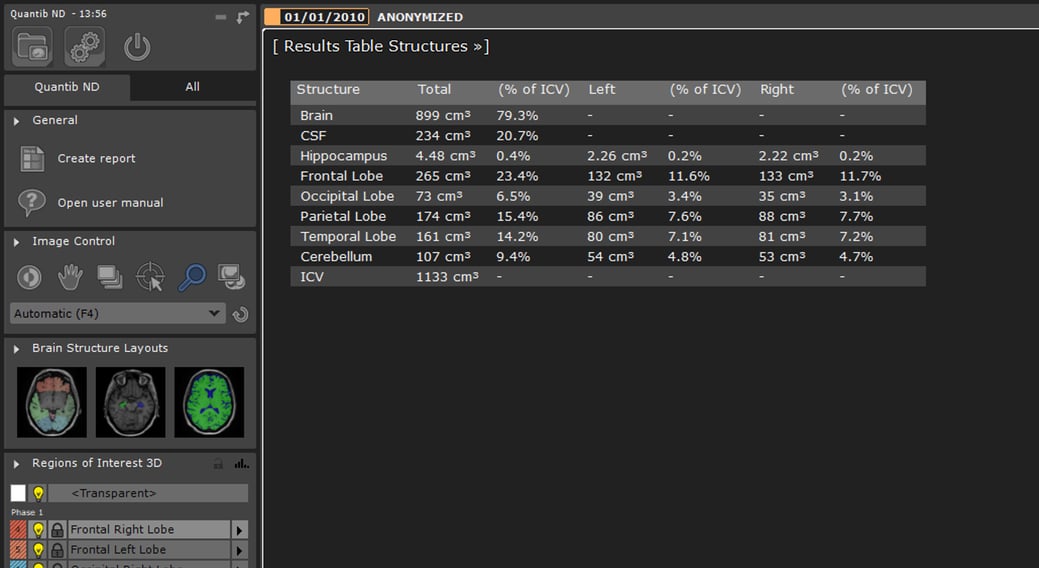 Brain Segmentation Software - Quantib Neurodegenerative (Quantib™ ND)