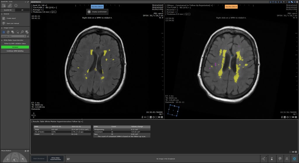 Brain Segmentation Software - Quantib Neurodegenerative (Quantib™ ND)