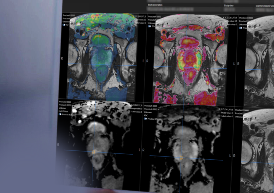 Prostate MRI Reading Software | Quantib® Prostate