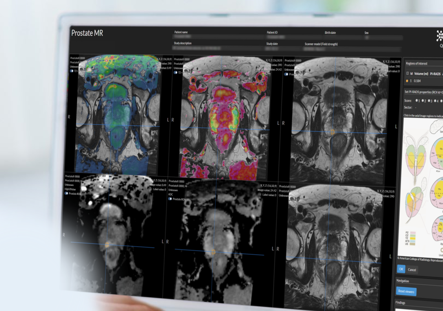 Prostate MRI Reading Software | Quantib® Prostate