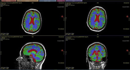 Quantib Brain Radiology Software | Quantib BV