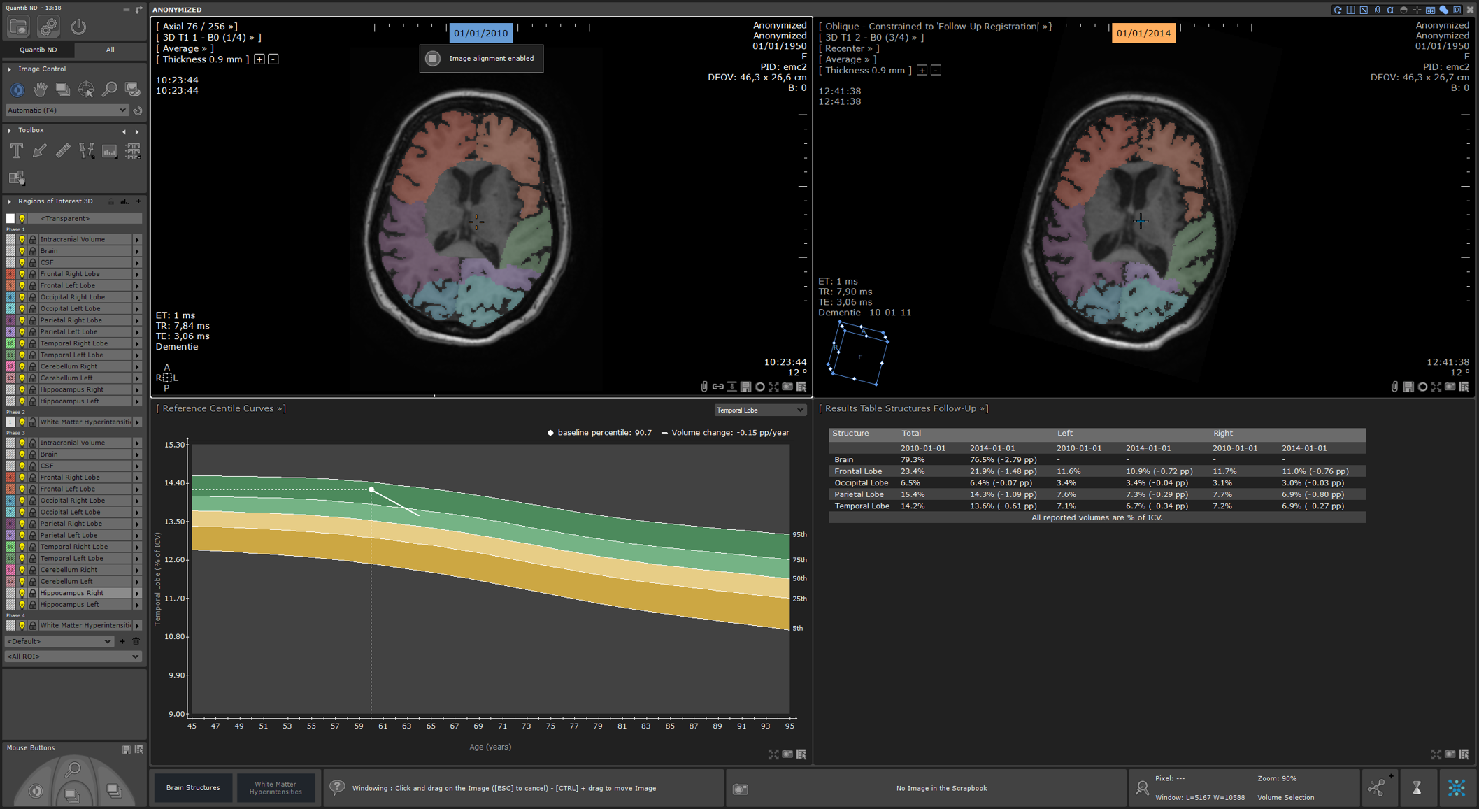 Quantib Presents Revolutionary Software for Dementia and MS Detection ...